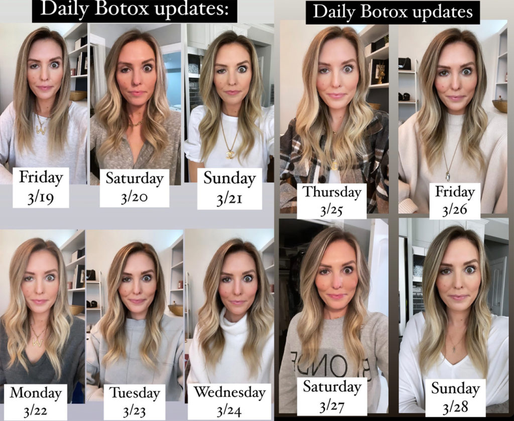 #Influencer With BOTCHED Botox Injection Documents Horrible Side ...