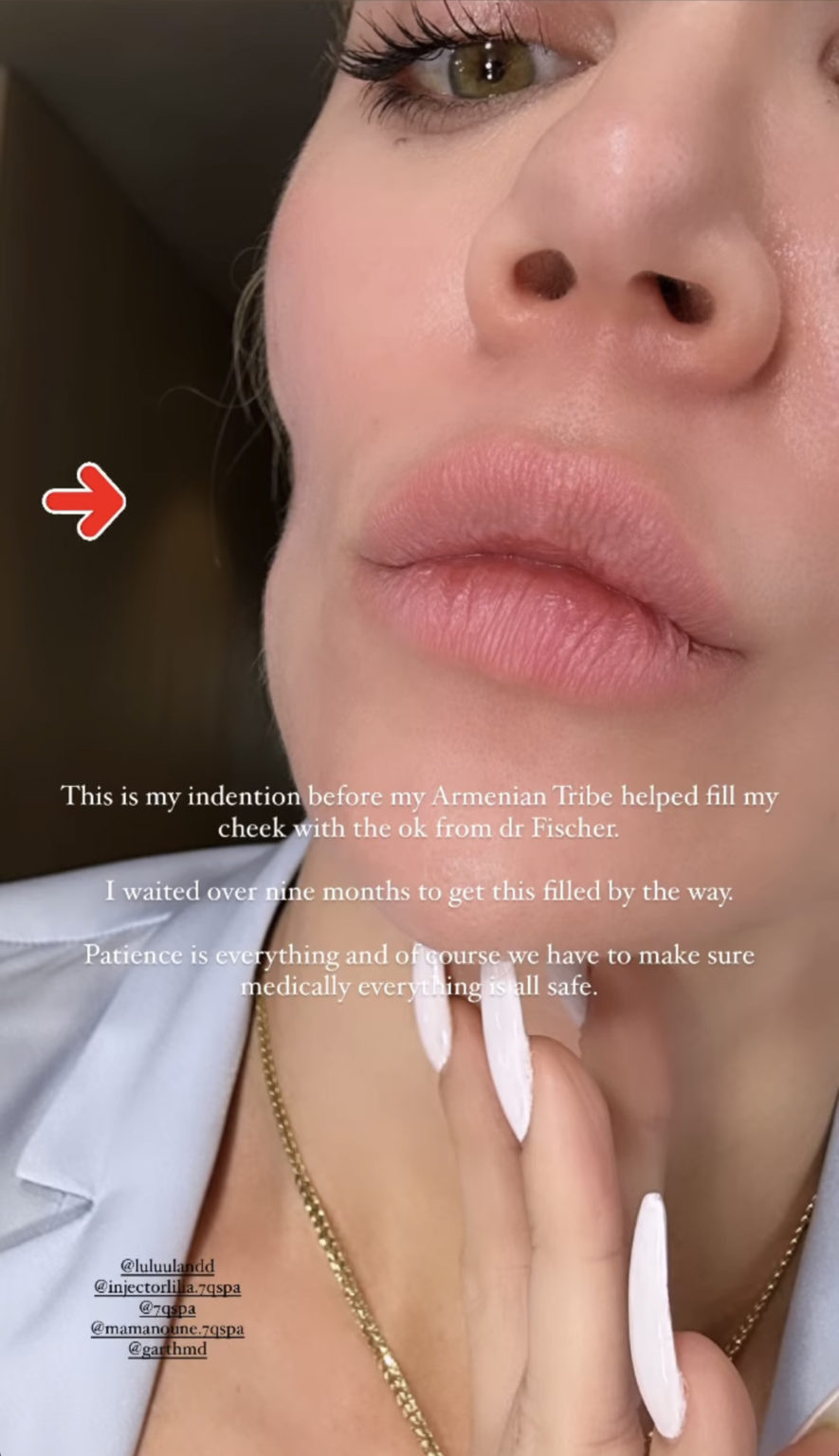 Khloé Kardashian Reveals How She's Dealing With Severe Cheek ...