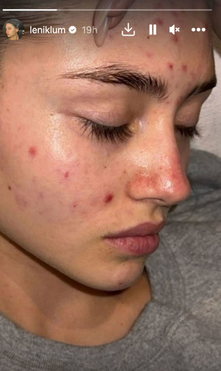 Heidi Klum's Model Daughter Leni Shares Makeup-Free Face Covered In ...