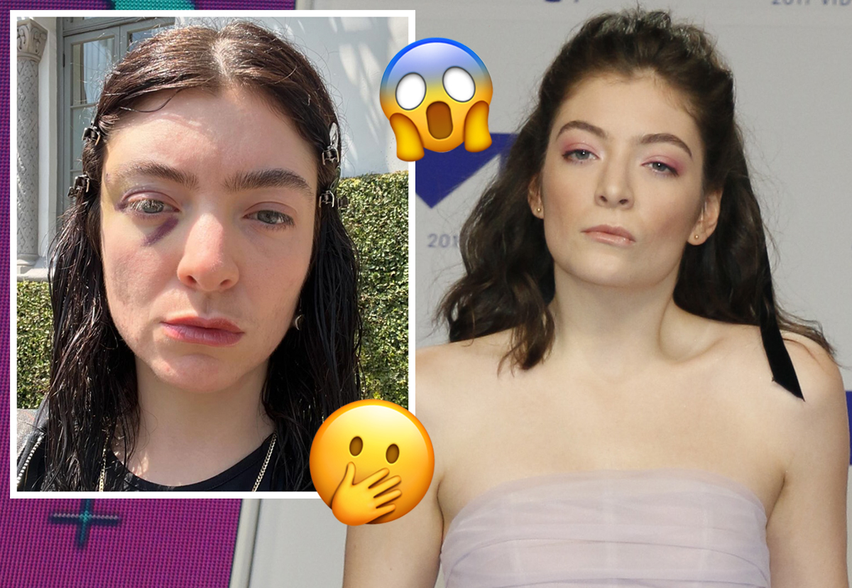 Lorde Terrifies Fans By Posting A Series Of Unsettling Black Eye Photos ...