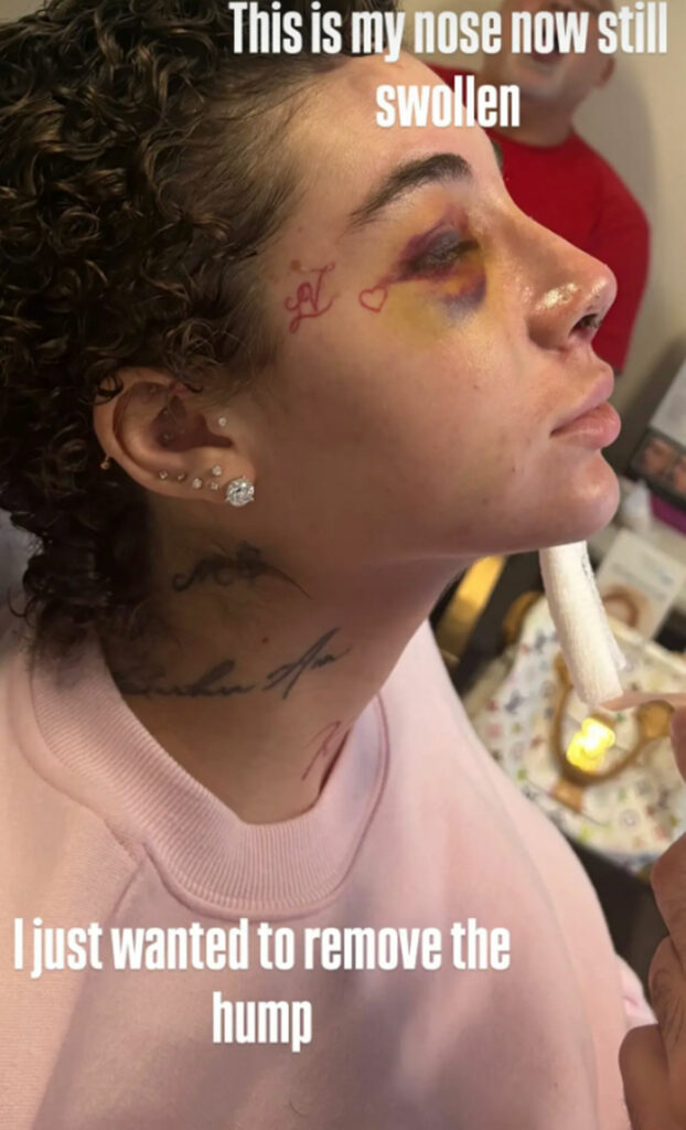 Bhad Bhabie Reveals She Got Nose Job And Clarifies Cancer Diagnosis ...