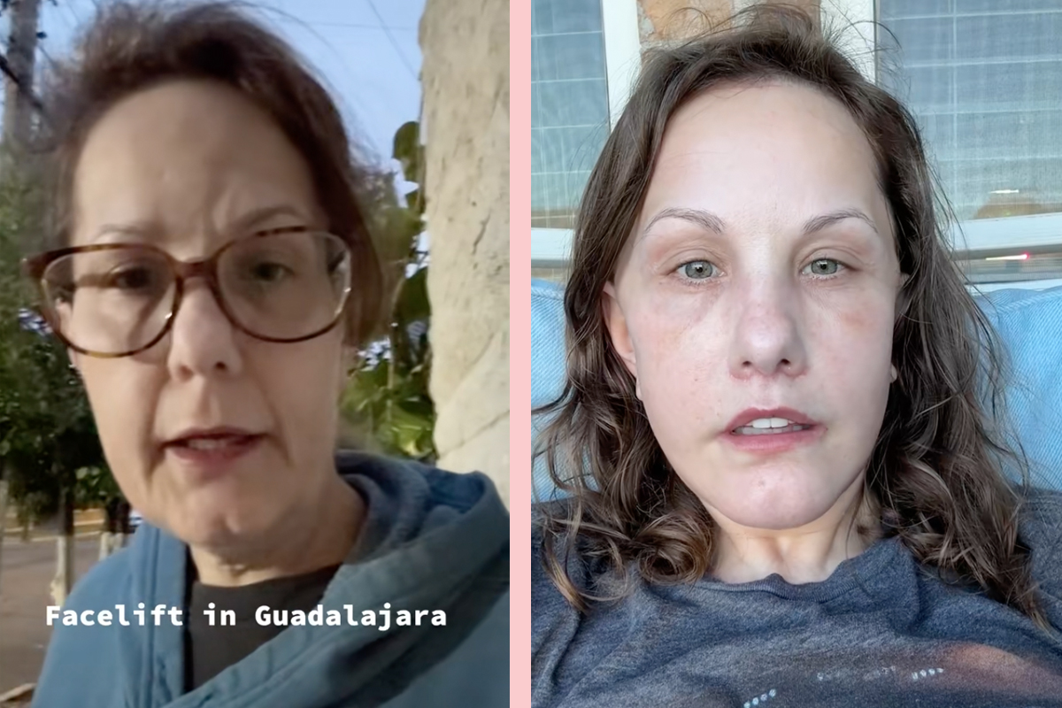 TikToker's Before-And-After Facelift Photos Have Fans GAGGED! - Perez ...