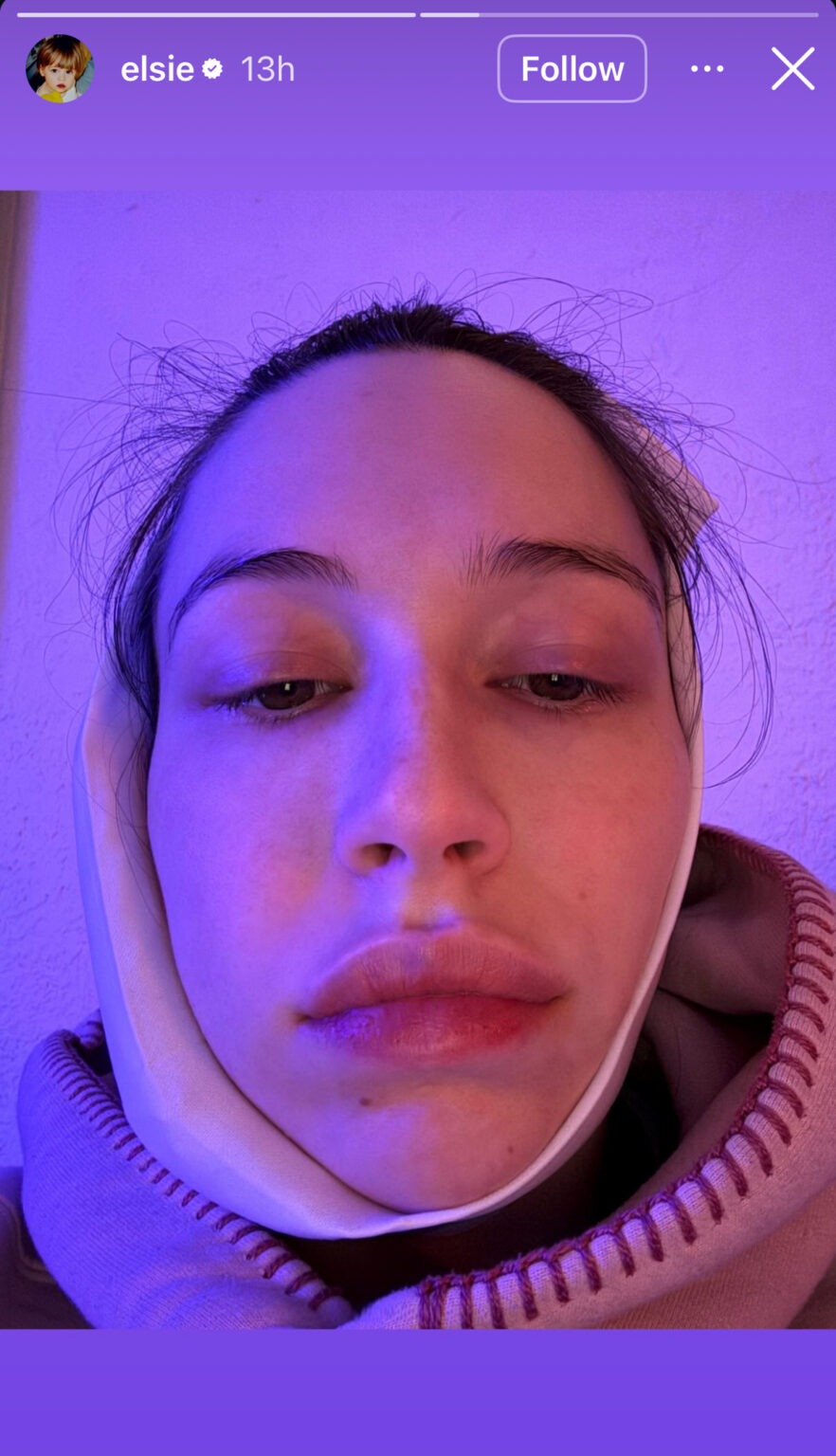 Pete Davidson's Girlfriend Elsie Hewitt Had To Get WHAT Removed Day ...